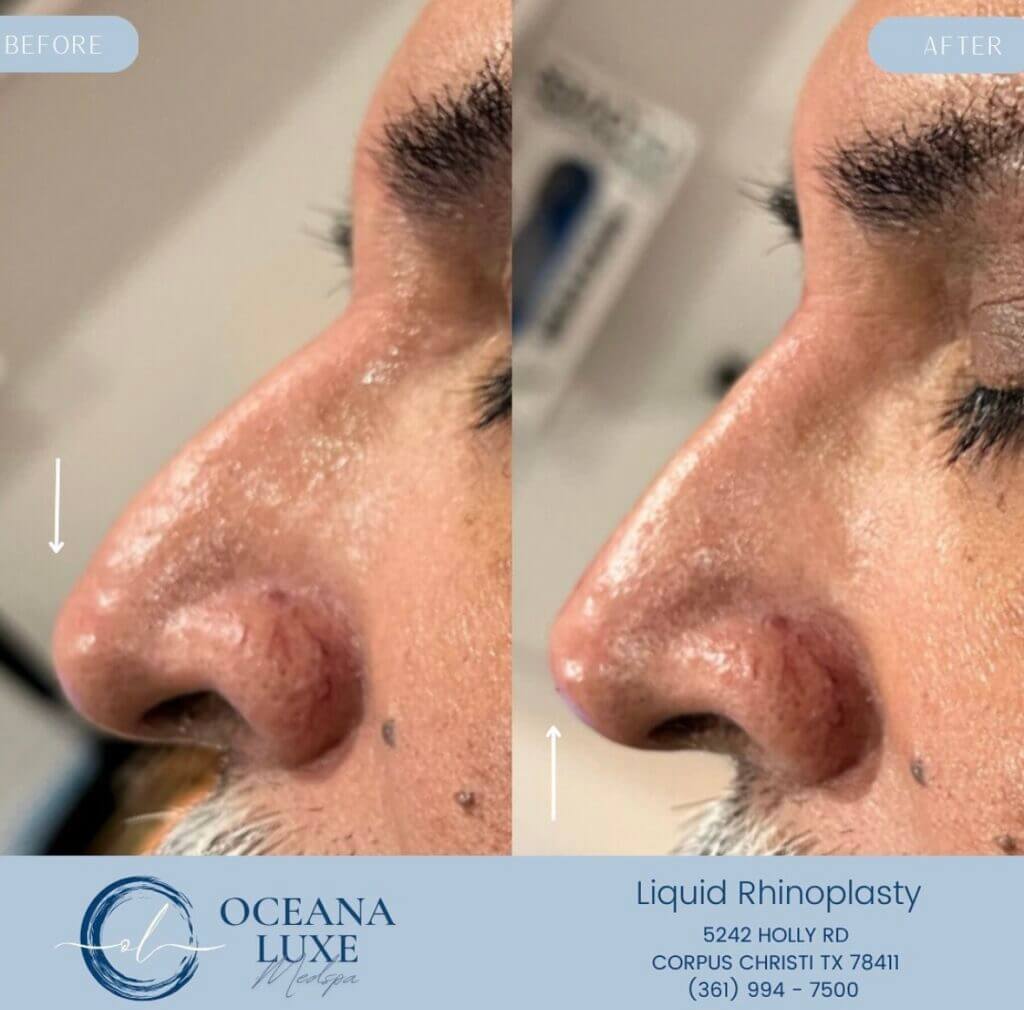 Medspa Before and After Images at Oceana Luxe Medspa